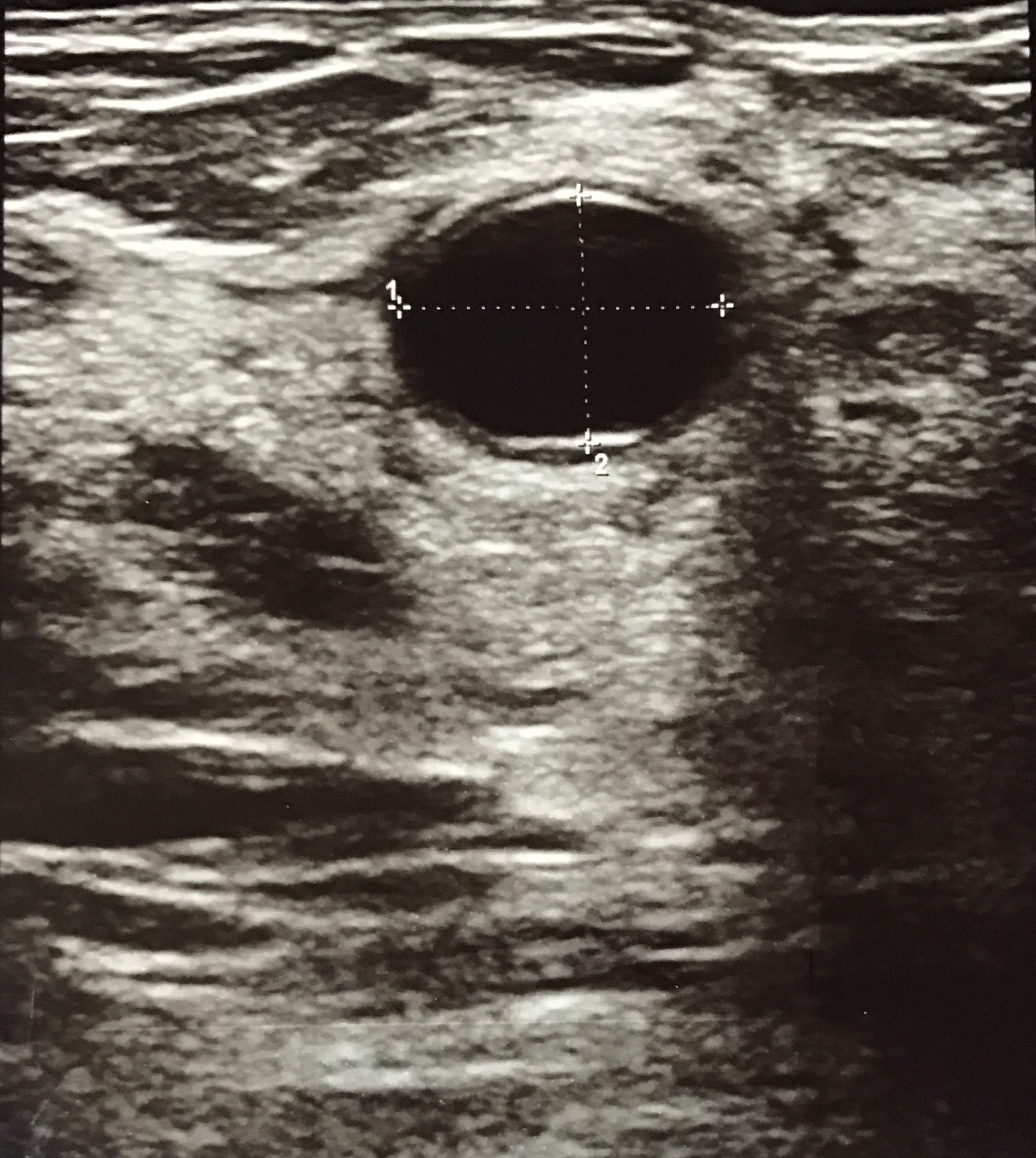Brust-Ultraschall (Mamma-Sonographie) – Frauenärzte Wallstraße